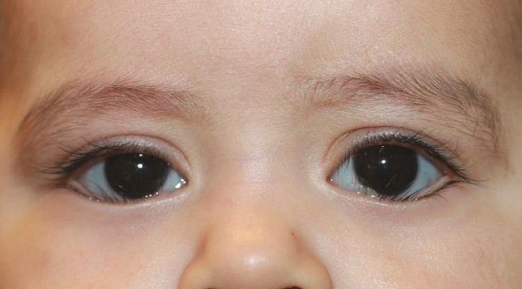 Epiblepharon - American Association for Pediatric Ophthalmology and ...