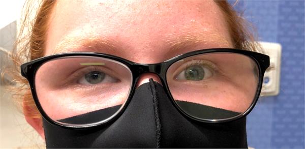 Dissociated Vertical Deviation - American Association for Pediatric ...