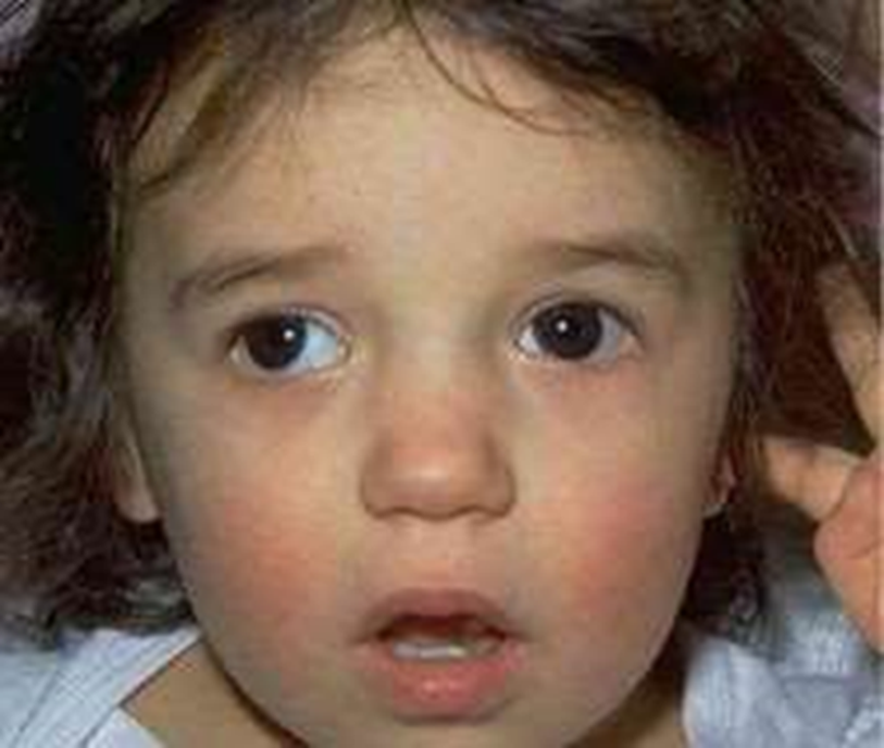 Exotropia - American Association for Pediatric Ophthalmology and Strabismus