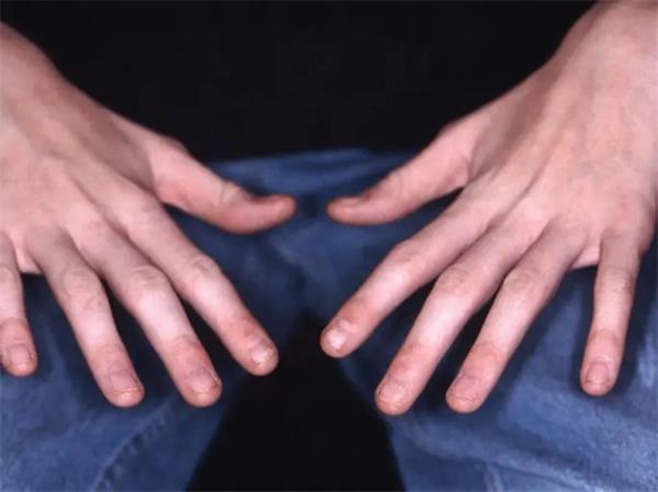 Marfan Syndrome - American Association for Pediatric Ophthalmology and ...