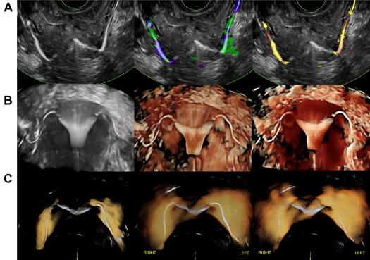 APPPG Procedure - HyFoSy and HyCoSy - Advanced Practice Provider ...