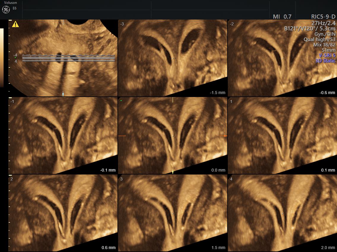 APPPG Procedure - HyFoSy and HyCoSy - Advanced Practice Provider ...