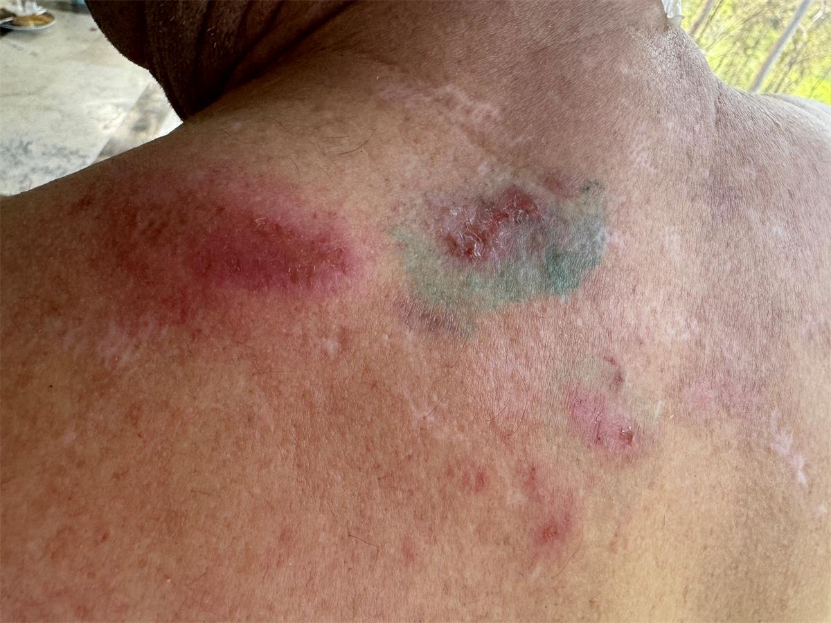 Diabetic Sores | Type 2 - Connect