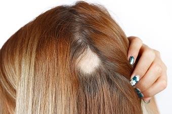 Alopecia Specimen Orientation