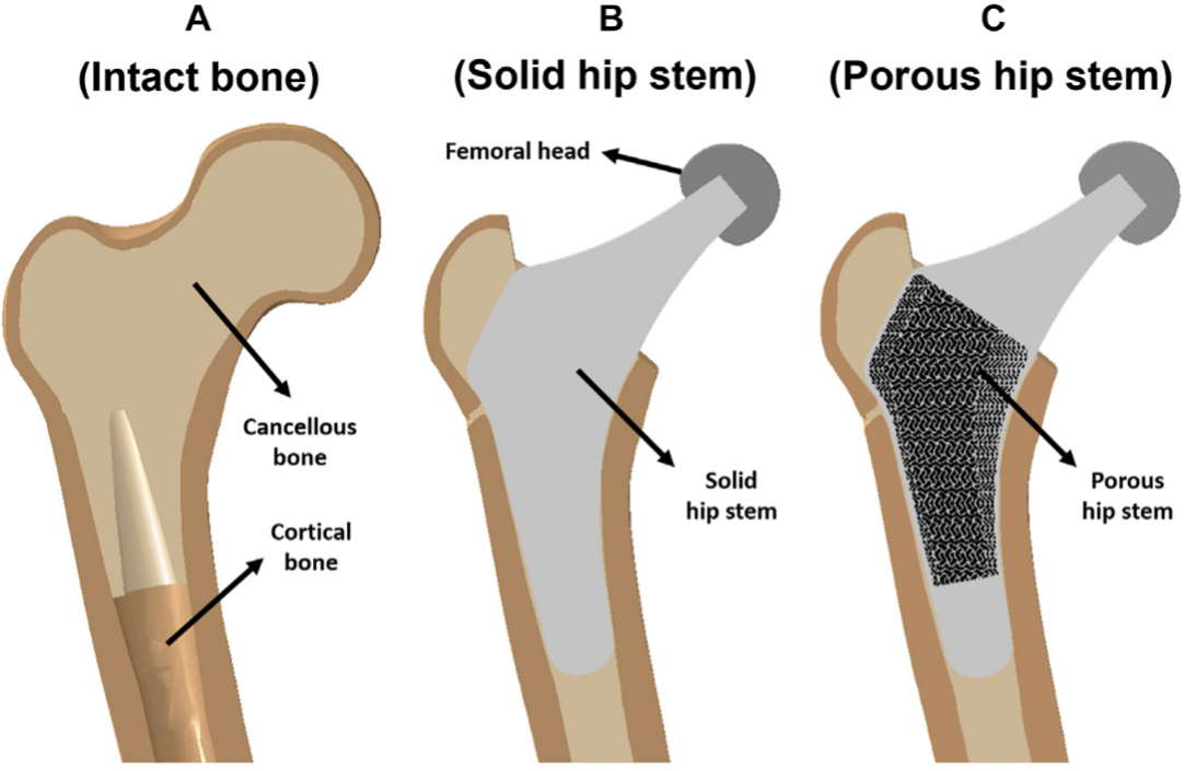 How To Design A Graded Hybrid Porous Hip Implant Stem To Reduce Stress Shielding And Bone Resorption